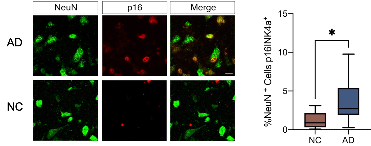 New Study Shows Senolytics can Potentially Treat Alzheimer’s Disease